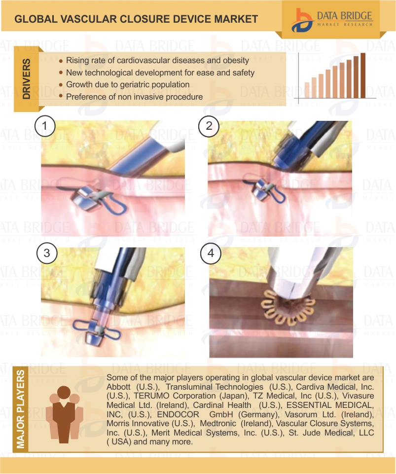 Vascular Closure Device Market 2017 Global Market Poised to Grow at a ...